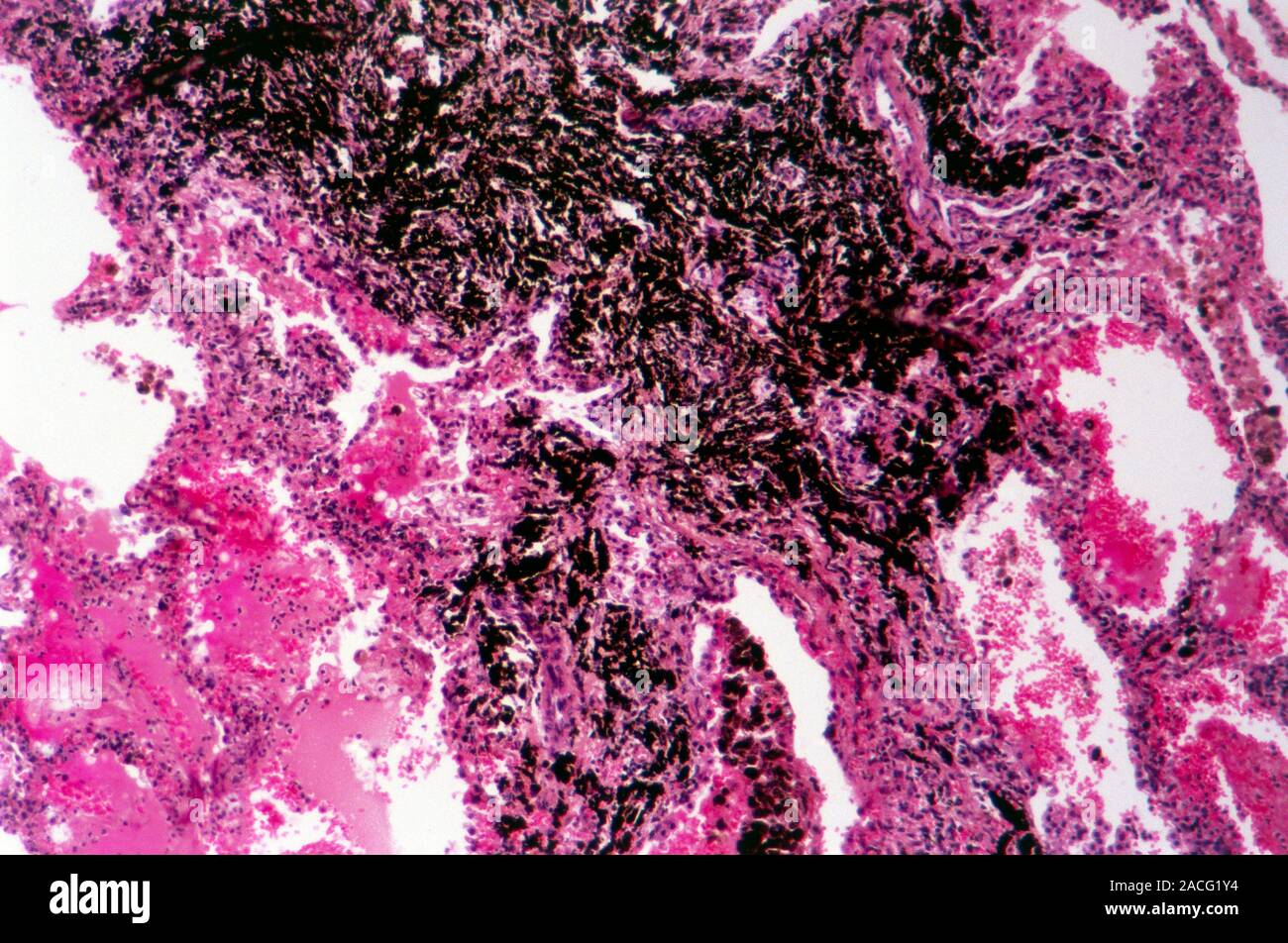 Fibrosis of the lung. Light micrograph of a section through a lung ...