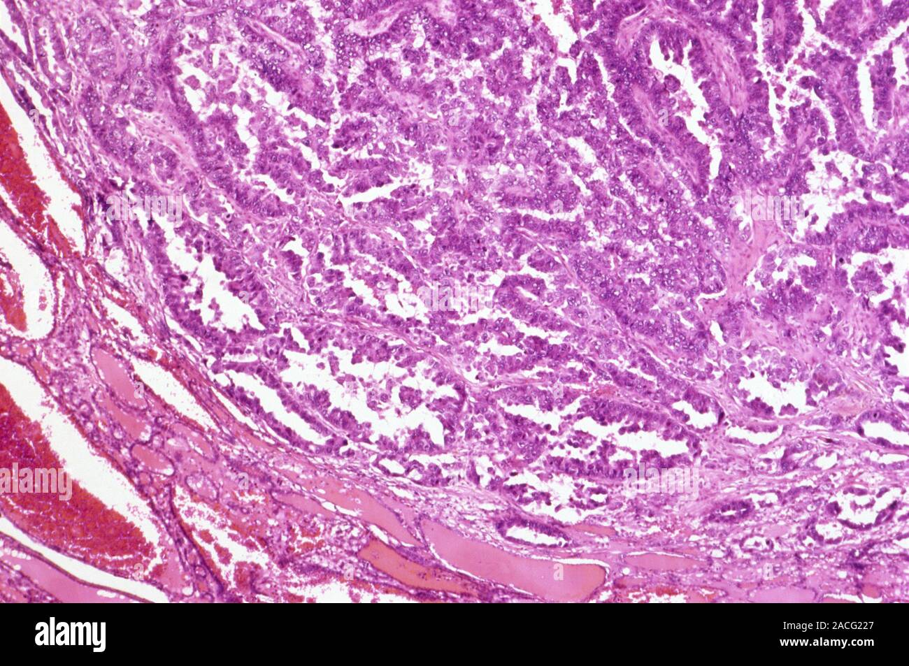 Thyroid cancer. Light micrograph of a section through a thyroid gland ...