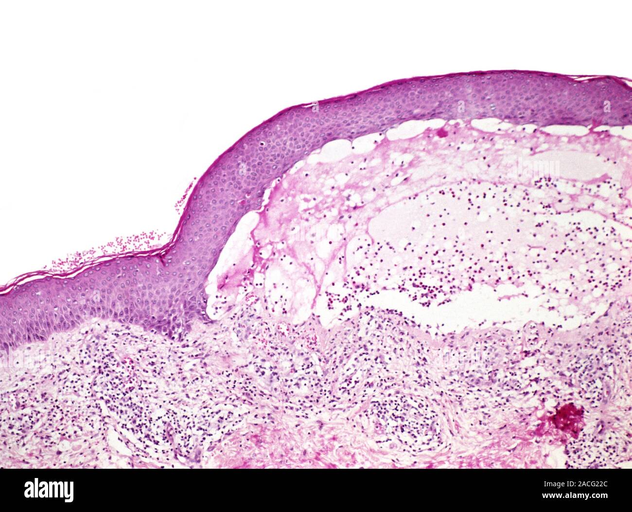 Blister. Light micrograph of a section through a bulla, or blister ...
