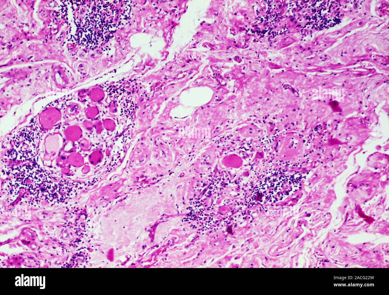 Thyroid cancer. Light micrograph of a section through a thyroid gland ...