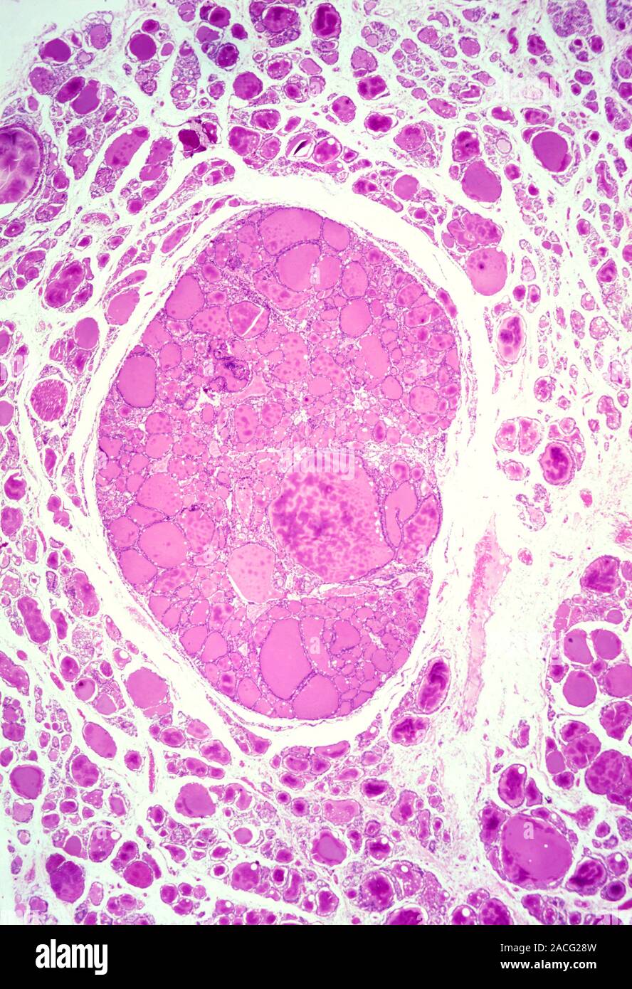 Thyroid nodule. Light micrograph of a section through a thyroid gland ...