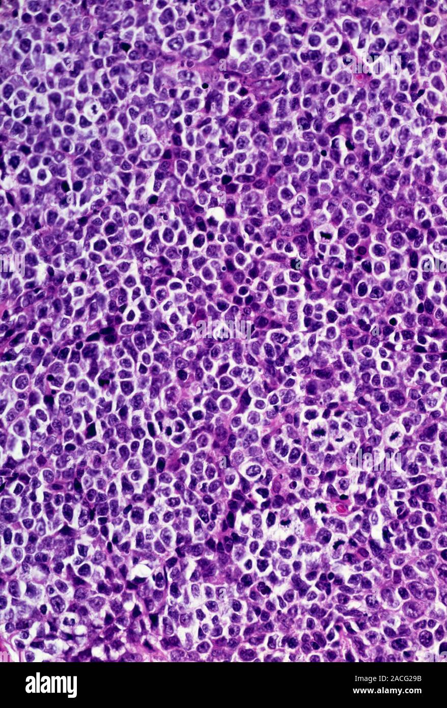 Thyroid cancer. Light micrograph of a section through a thyroid gland ...