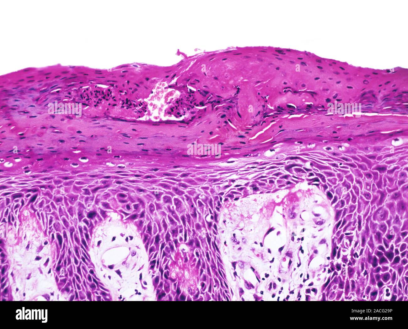 Thickened skin. Light micrograph of a section through skin that ...