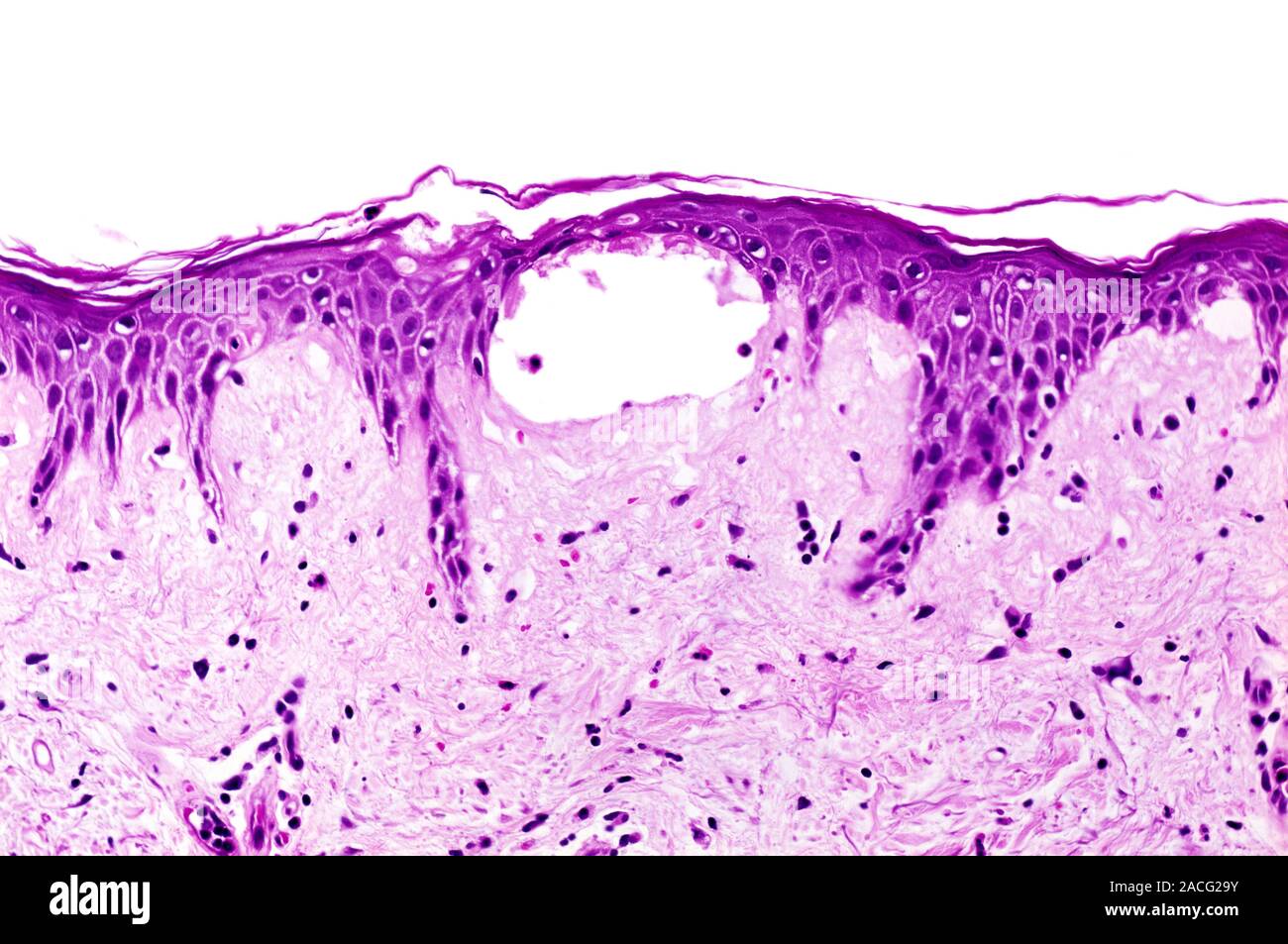 Small blister. Light micrograph of a section through the skin showing a ...