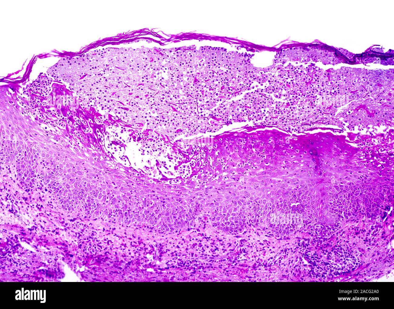 Pustule. Light micrograph of a section through the skin showing a ...