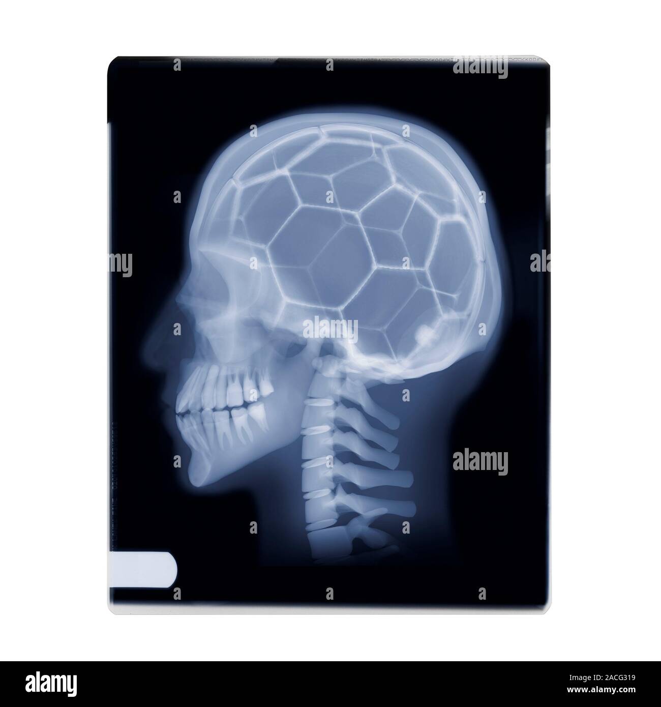 Football on the brain, conceptual X-ray image. X-ray image of a human ...