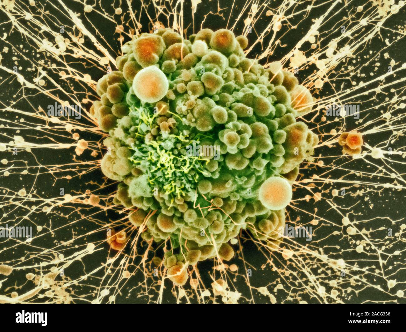 HeLa cell dying, coloured scanning electron micrograph (SEM). This cell ...