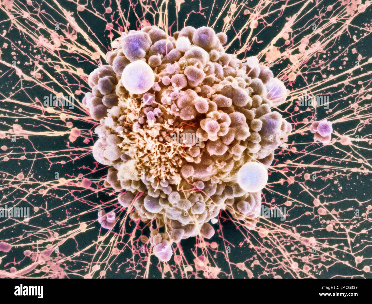 HeLa cell dying, coloured scanning electron micrograph (SEM). This cell ...
