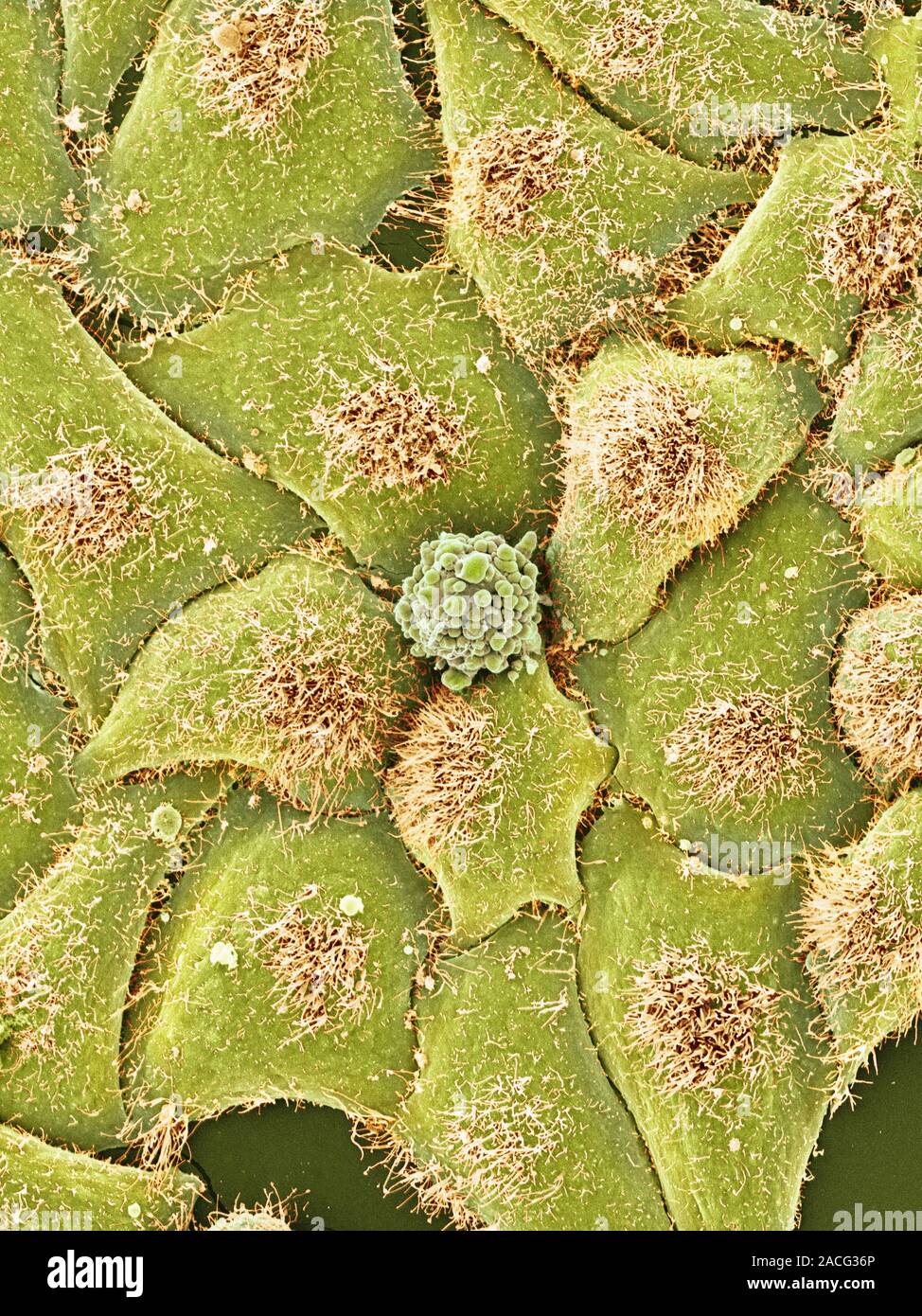 HeLa cells, coloured scanning electron micrograph (SEM). HeLa cells are ...