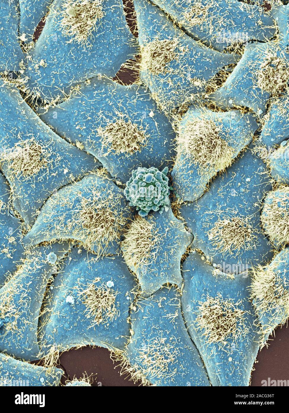 HeLa cells, coloured scanning electron micrograph (SEM). HeLa cells are ...