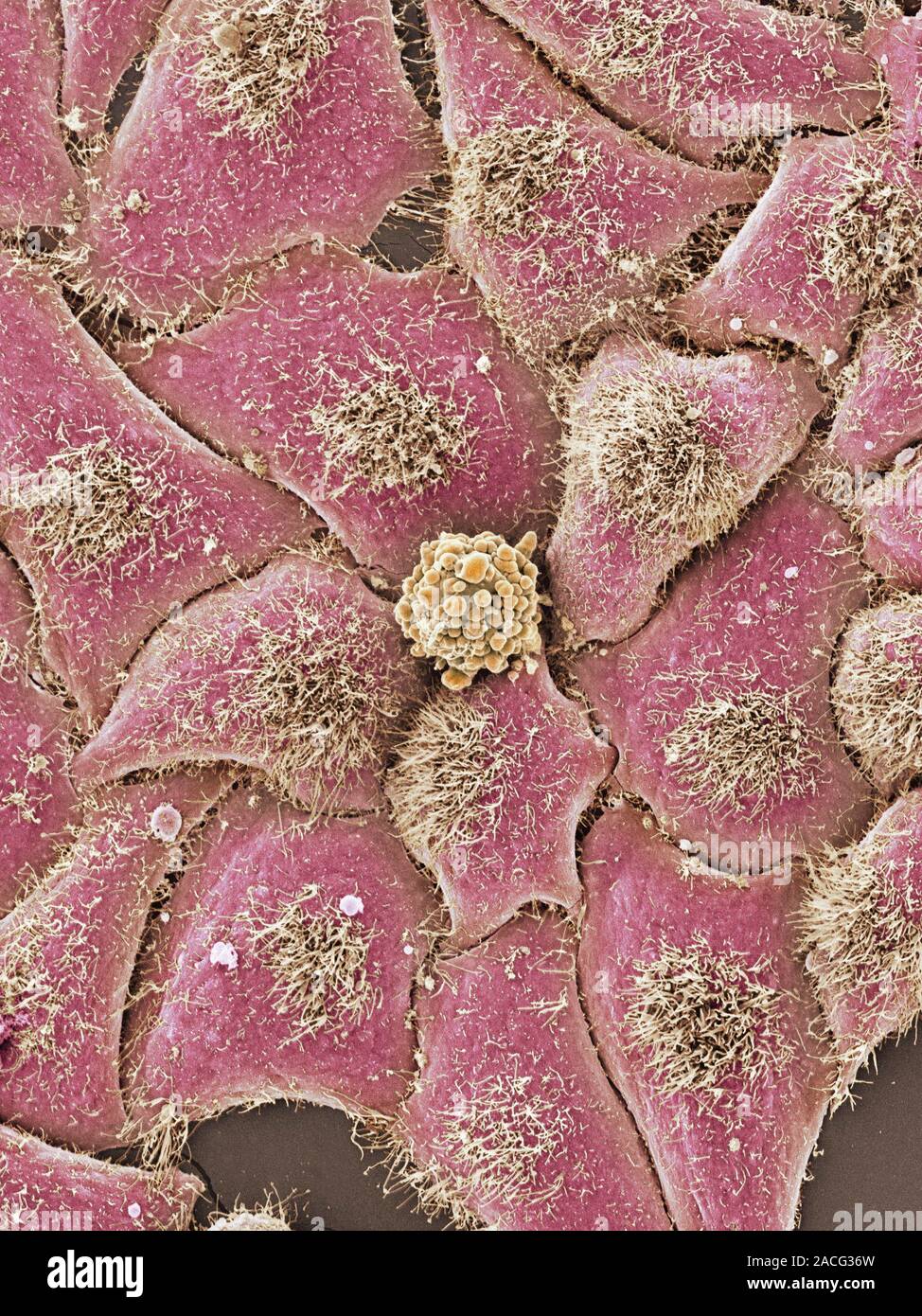 HeLa cells, coloured scanning electron micrograph (SEM). HeLa cells are ...
