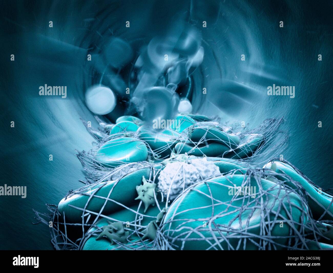 Blood clot. Computer artwork of a blood clot inside a blood vessel. A ...