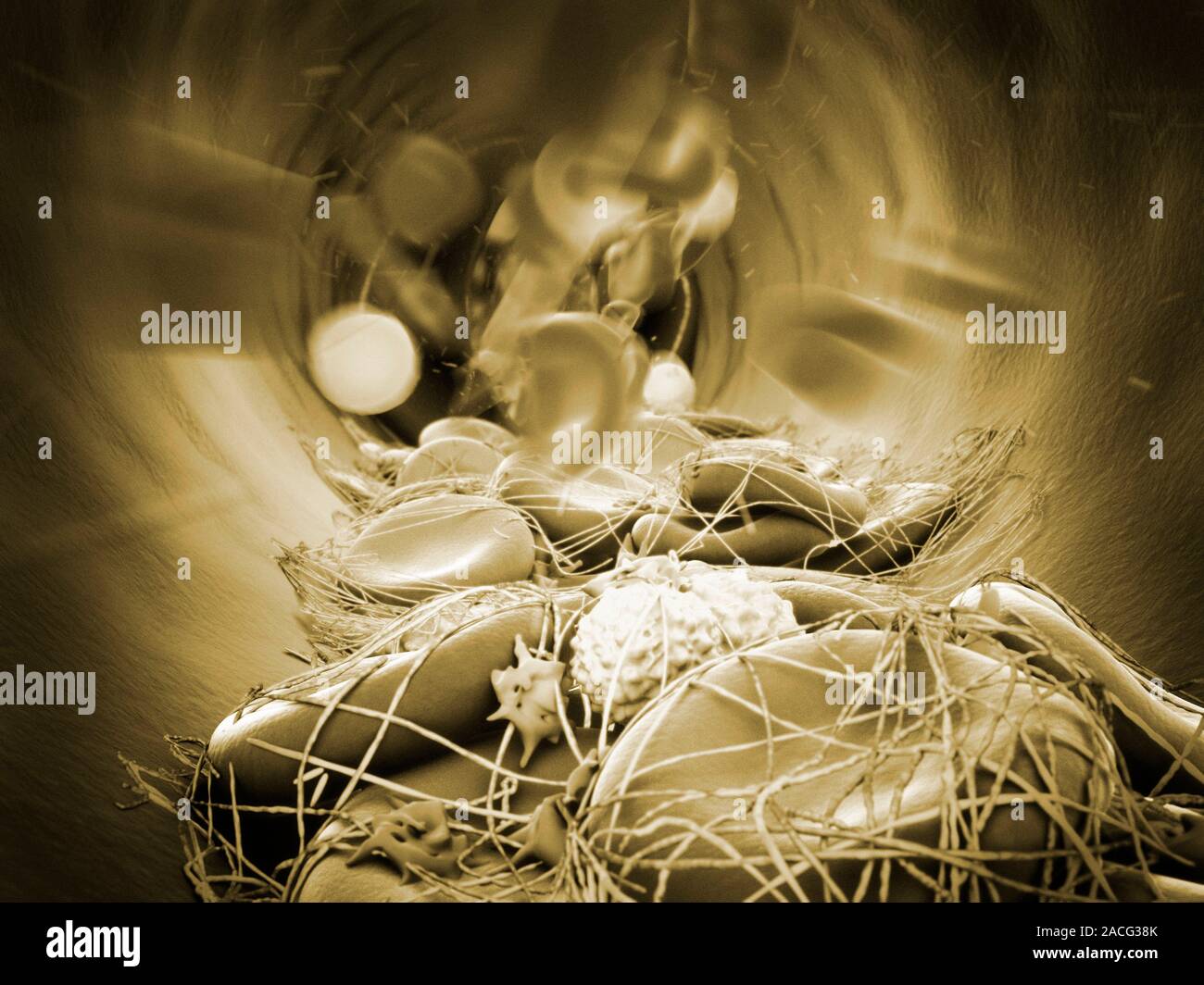 Blood clot. Computer artwork of a blood clot inside a blood vessel. A ...