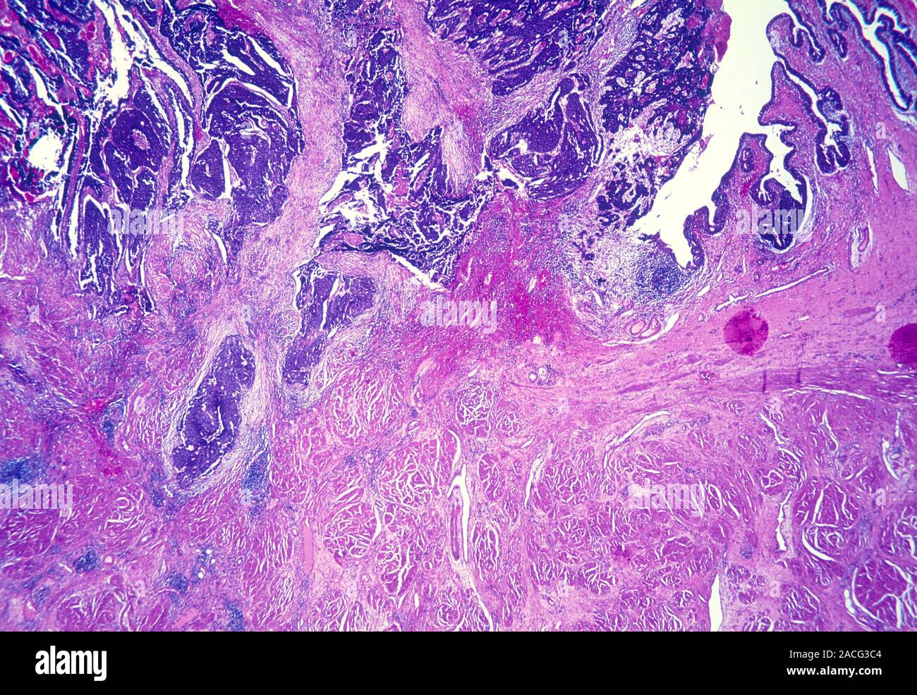 Ovarian tumour. Light micrograph of a section through a benign (non ...