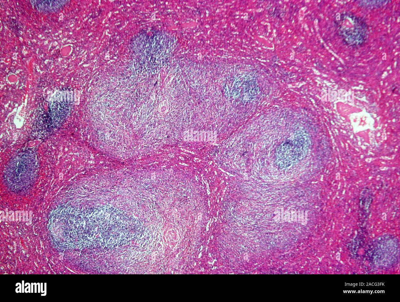 Hodgkin's disease. Light micrograph of a section through a lymph node ...