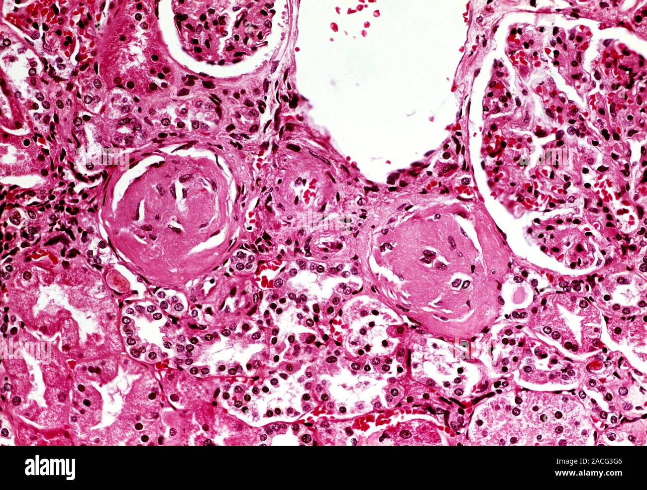 Hypertensive kidney. Light micrograph of a section through a kidney ...