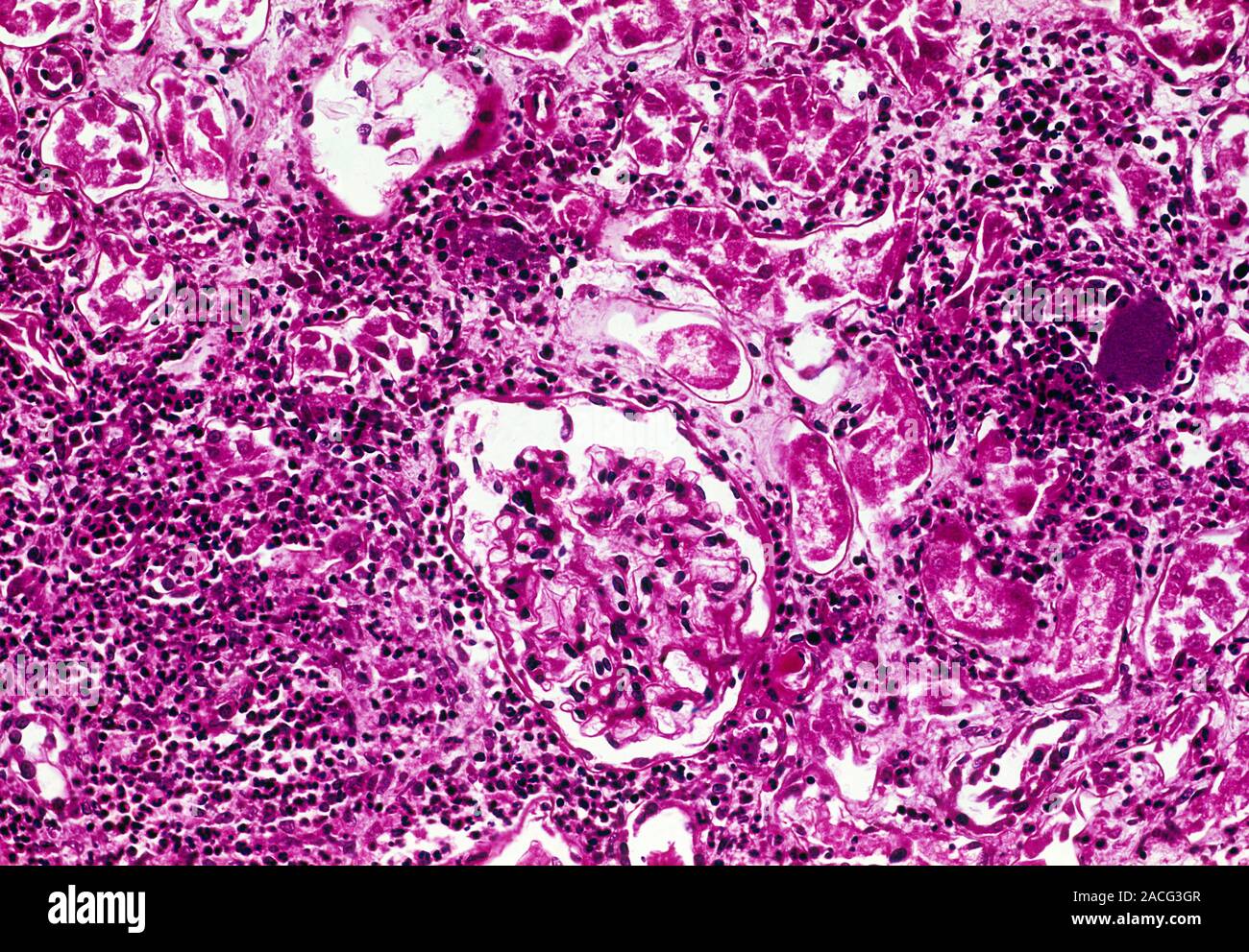 Kidney infection. Light micrograph showing a section through a kidney ...