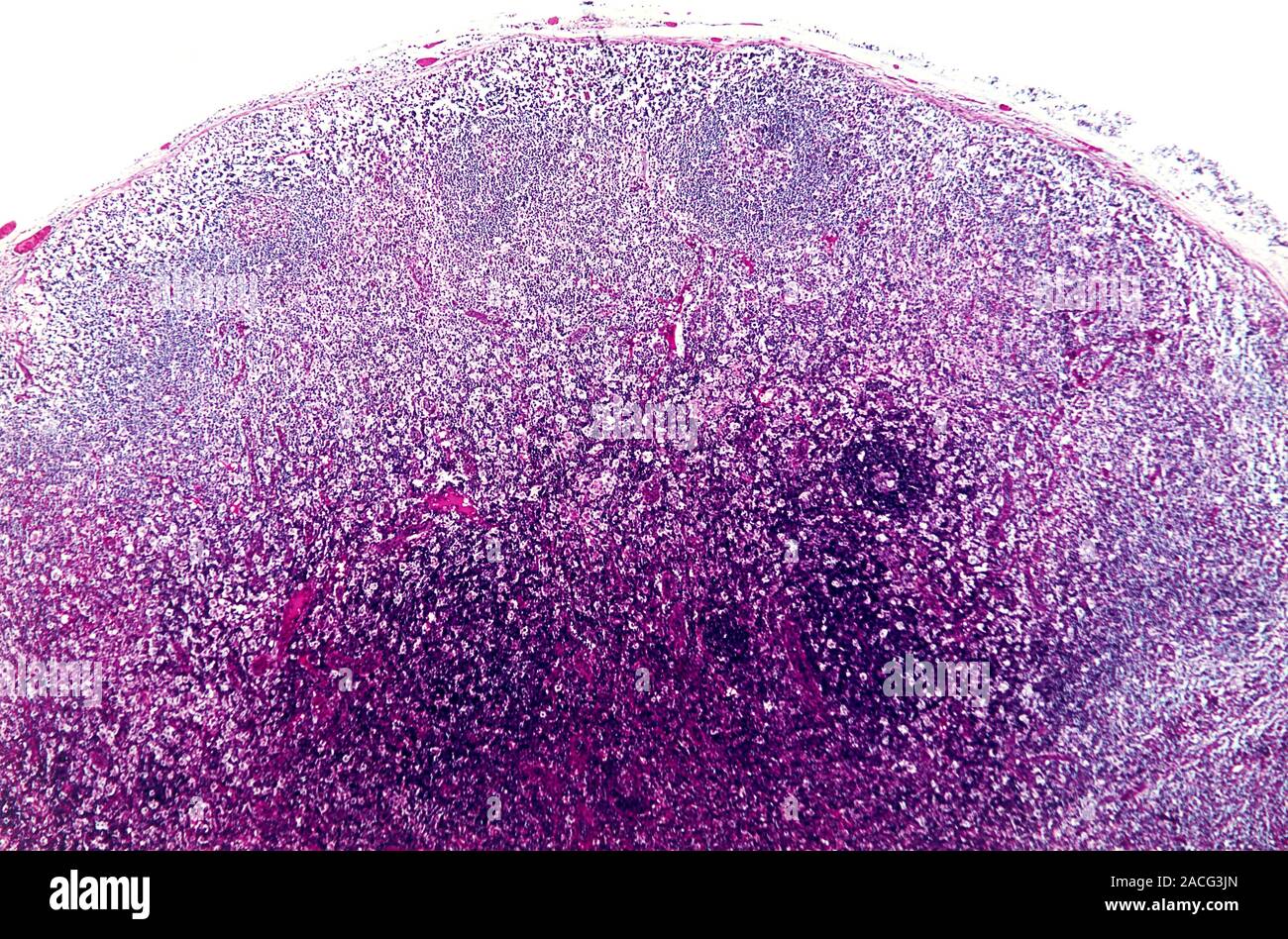Lymph node hyperplasia. Light micrograph of a section through a lymph ...