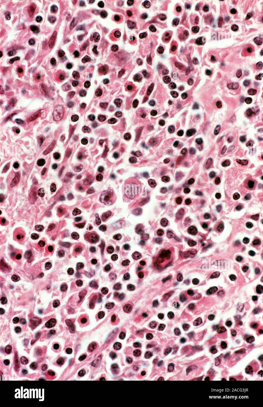 Hodgkin's disease. Light micrograph of a section through a lymph node ...