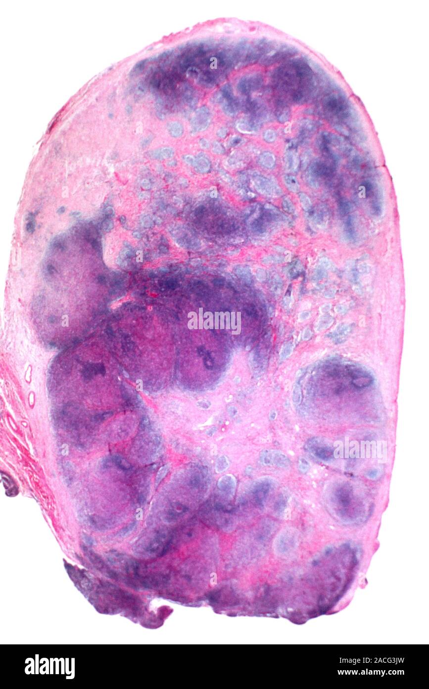Hodgkin's disease. Light micrograph of a section through a lymph node ...