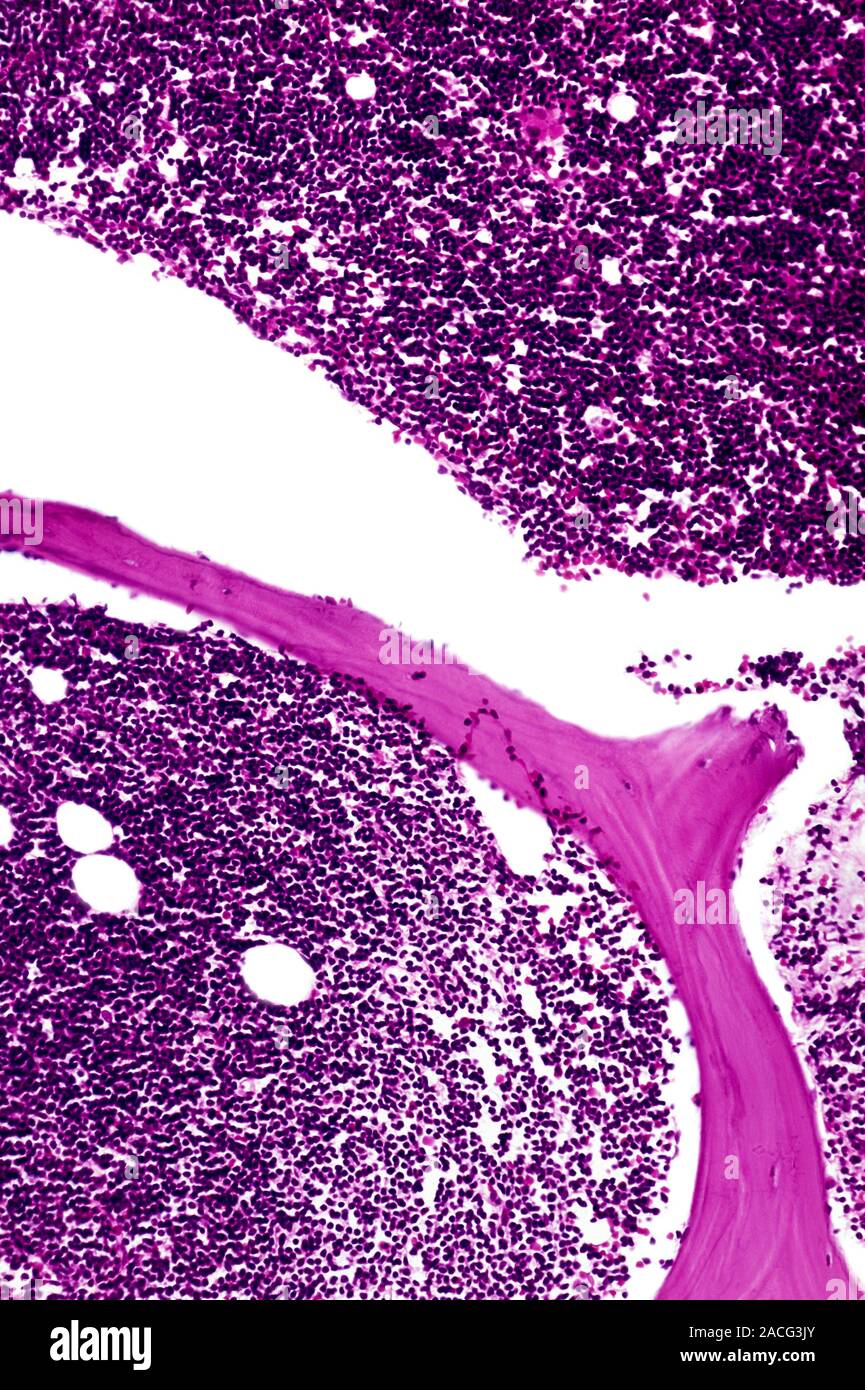 Bone marrow leukaemia. Light micrograph of a section through bone ...