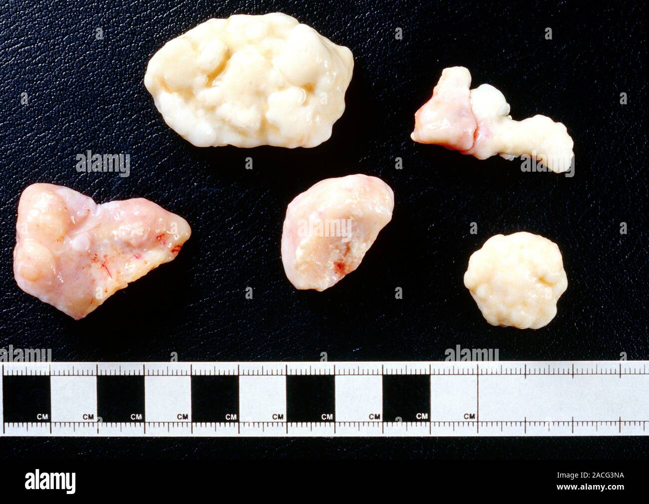 Benign bone tumours. These non-cancerous lumps of bone have been ...