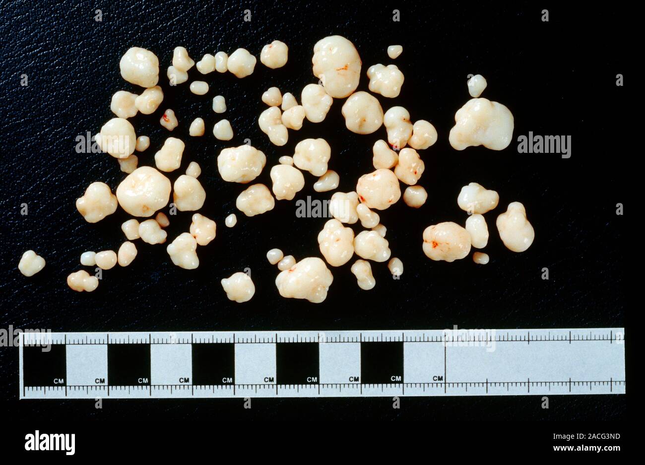 Benign bone tumours. These non-cancerous lumps of bone have been ...