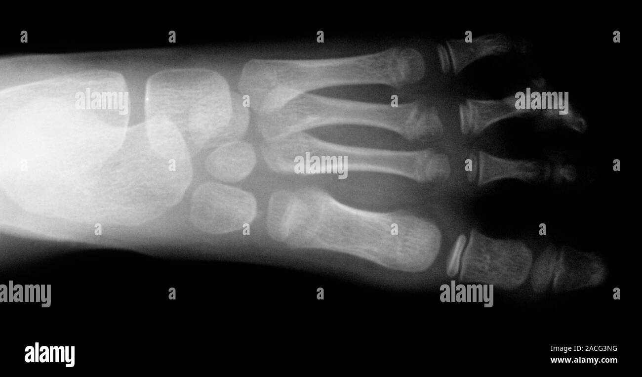 Missing toe birth malformation. X-ray showing the foot of a person with ...