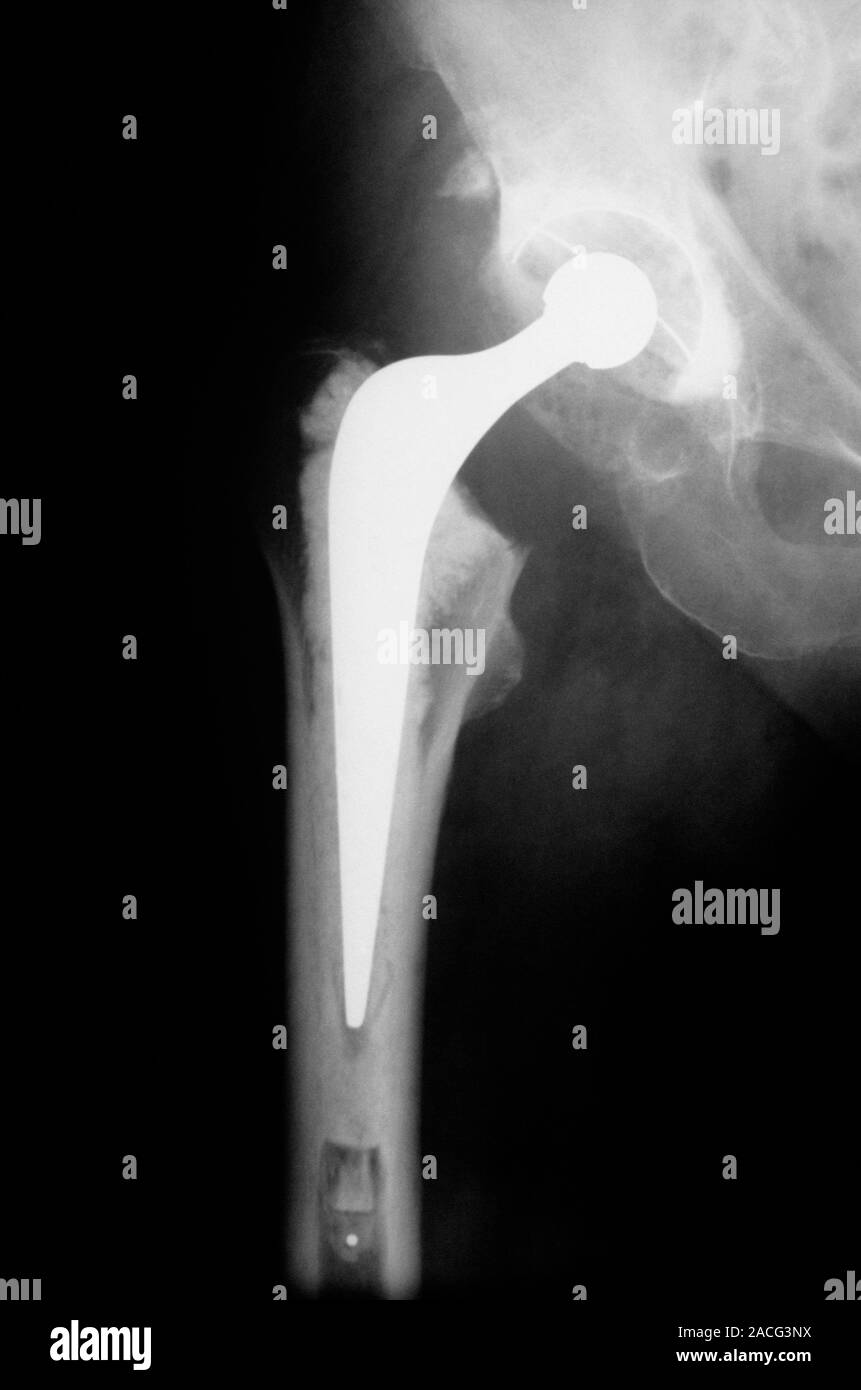 Total hip replacement. X-ray of the hip of a patient who has had a ...