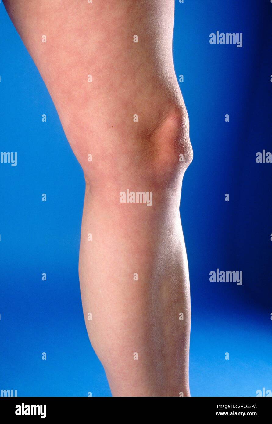 Bursitis of the knee. Swollen knee of a person with prepatellar ...