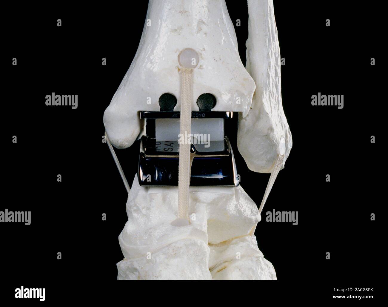 Replacement ankle joint. Model showing a prosthetic ankle joint (black ...
