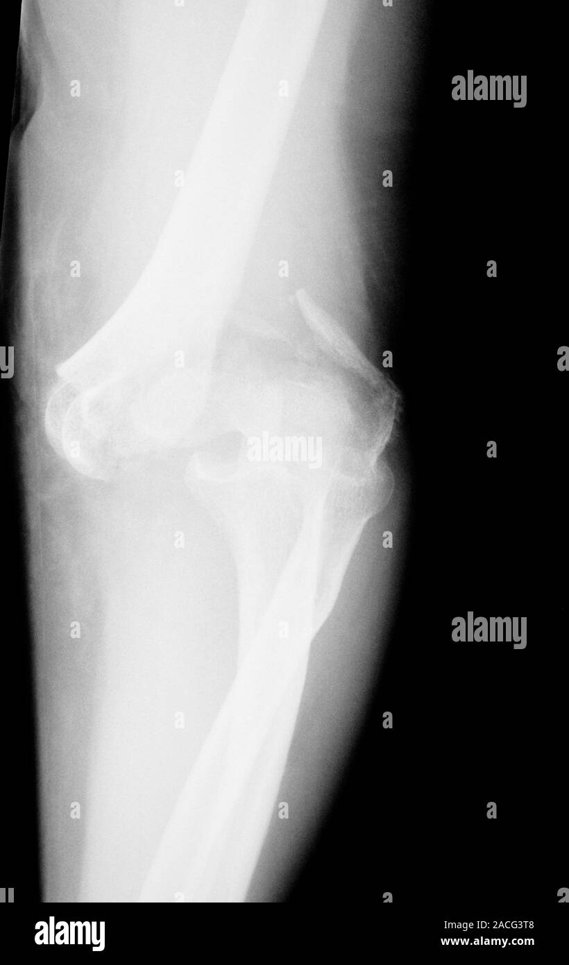 Fractured elbow. X-ray of the arm of a patient with a fractured elbow ...