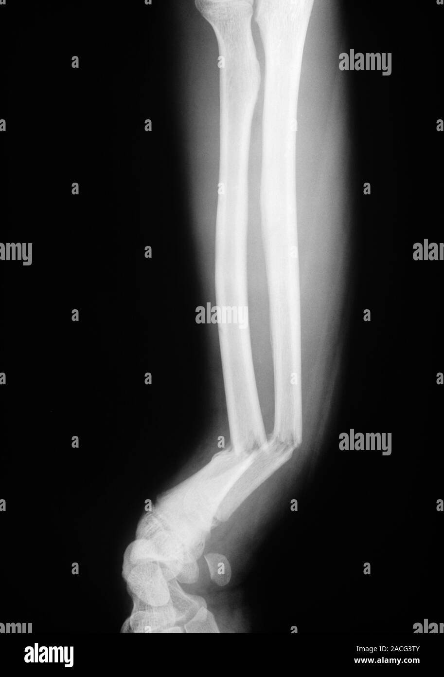 Xray Broken Arm