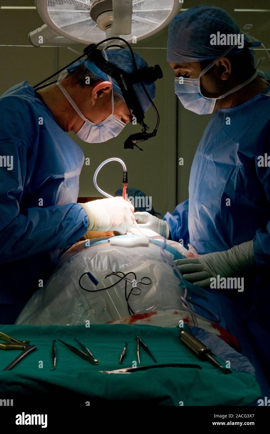 Spinal surgery. Surgeons operating on a patient's spine. The camera ...