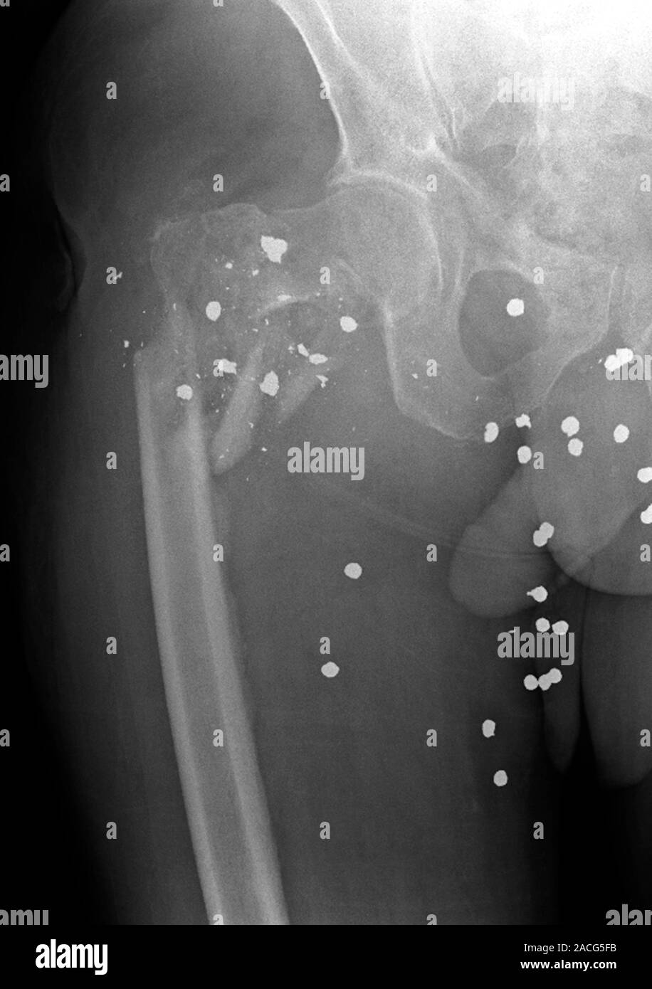 Firearm injury. X-ray of a patient who has been shot with a shotgun ...