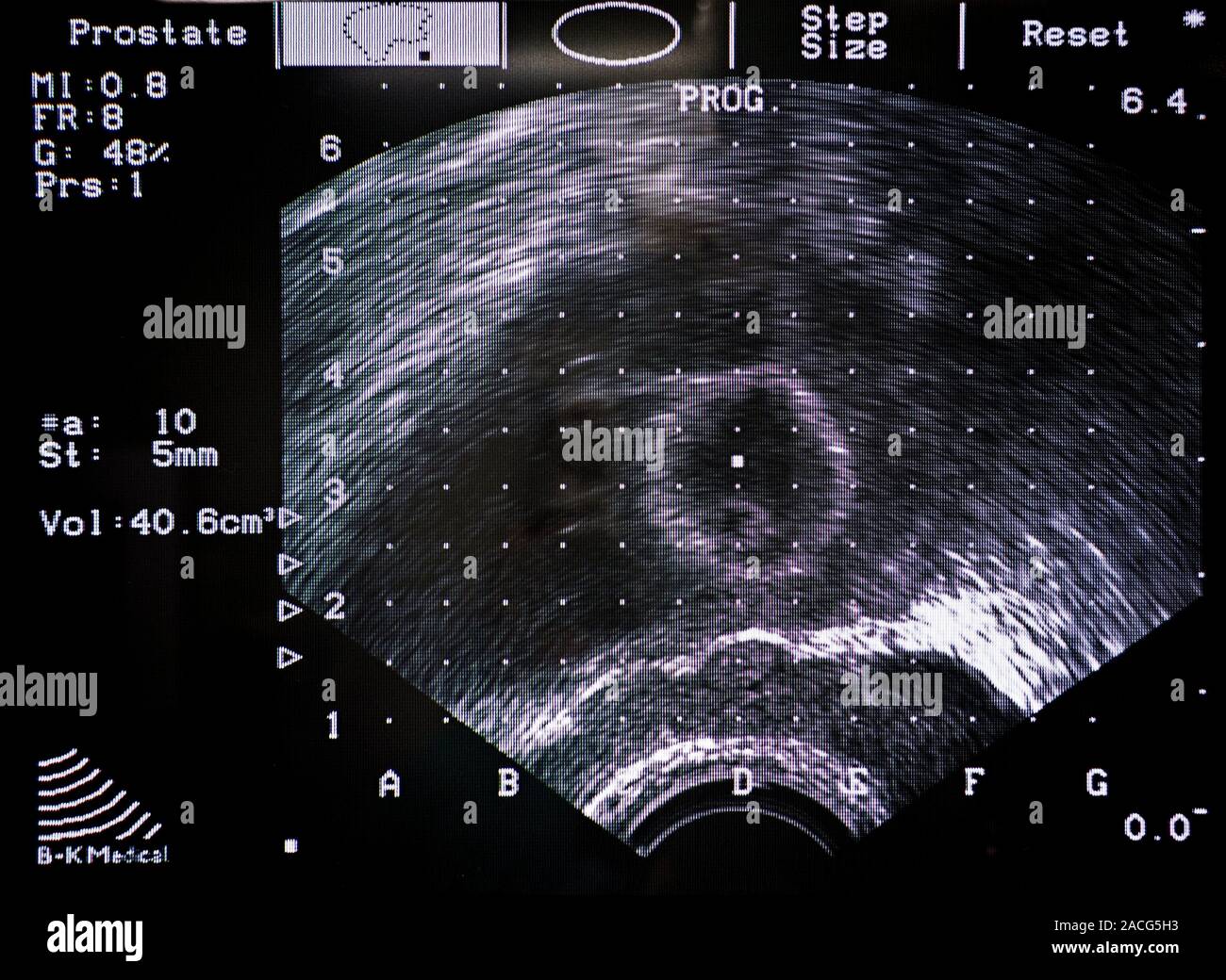 Prostate cancer radiotherapy scan. Ultrasound scan of the prostate ...