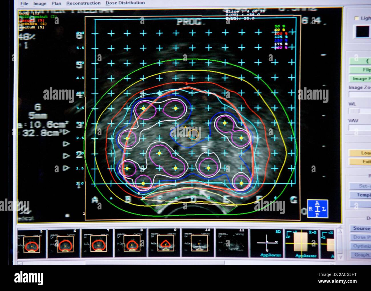 Prostate cancer radiotherapy planning. Display showing the results of a ...