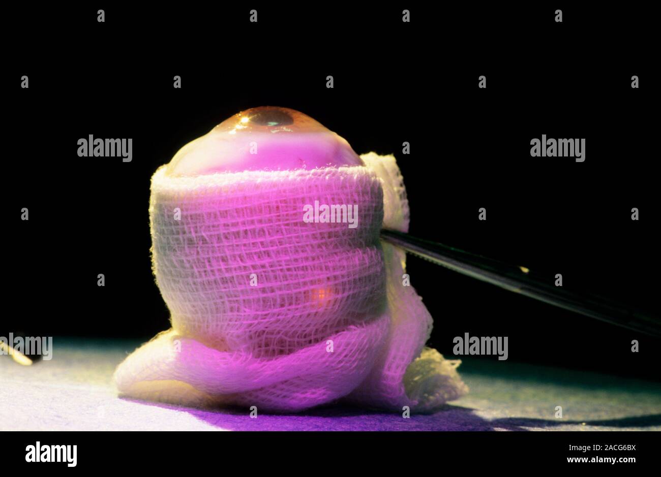 Human eye for cornea harvesting. Eyeball from a dead donor wrapped in ...