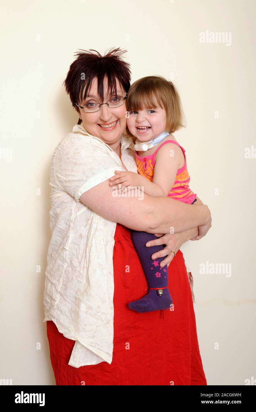 Child with tracheostomy. Young girl aged 2 1/2 years with a permanent ...