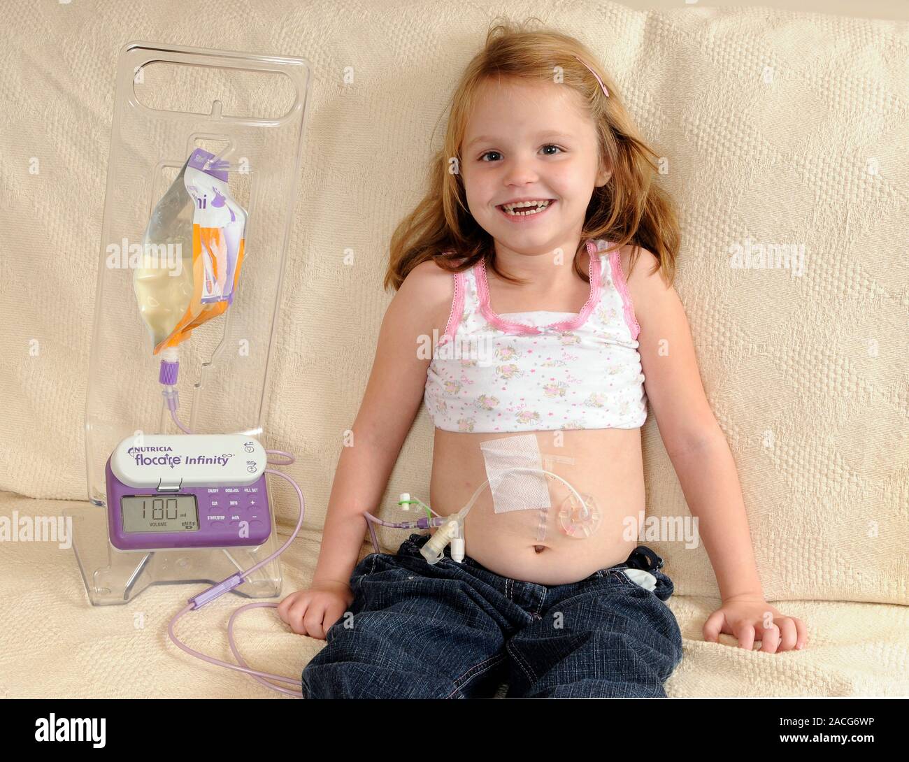 Five year old girl with a gastric feeding tube, also known as a 'G-tube ...