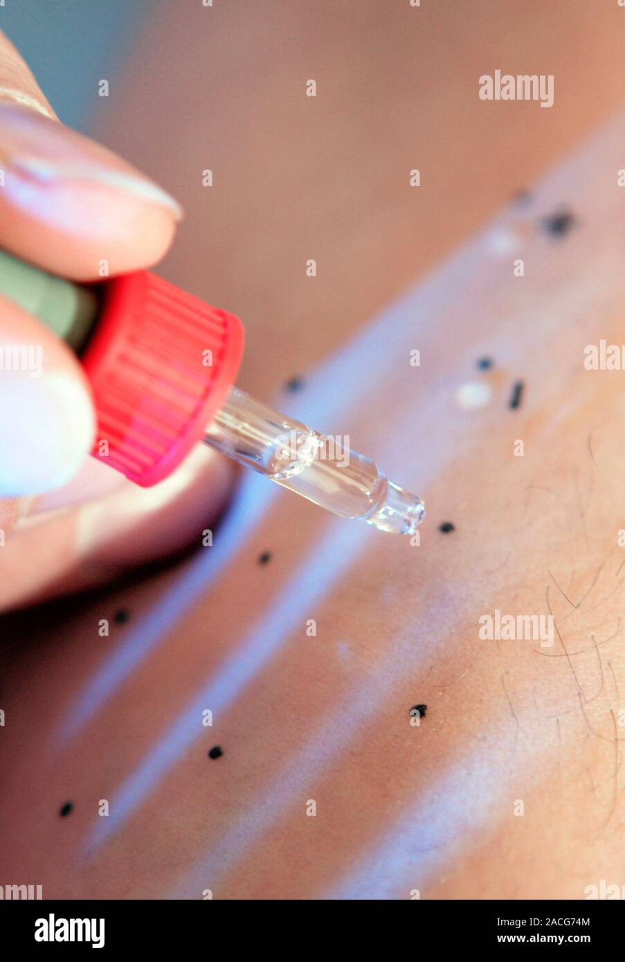 Allergy test. Medical worker applying a solution to the arm of a ...