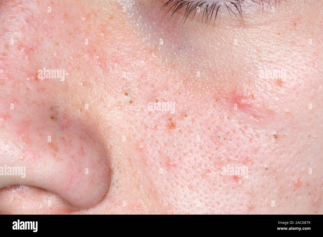 Close-up of the face of a teenaged male patient, showing acne vulgaris ...