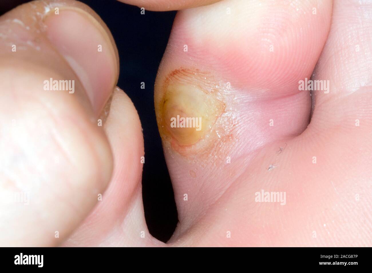 Close-up of the toe of a patient, showing an infection between the 4 ...