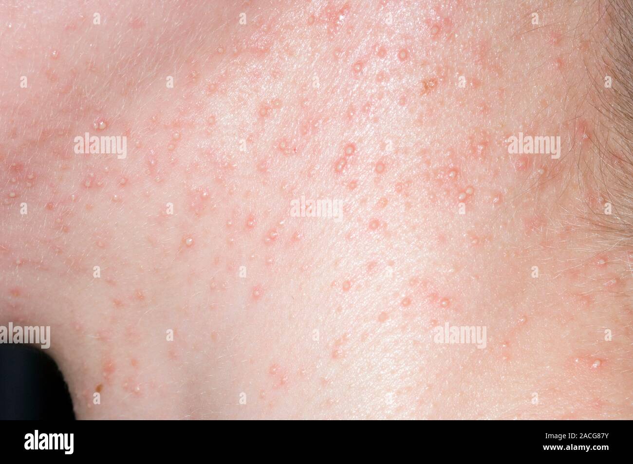 Close-up of the skin of the neck of a 25 year old female patient ...