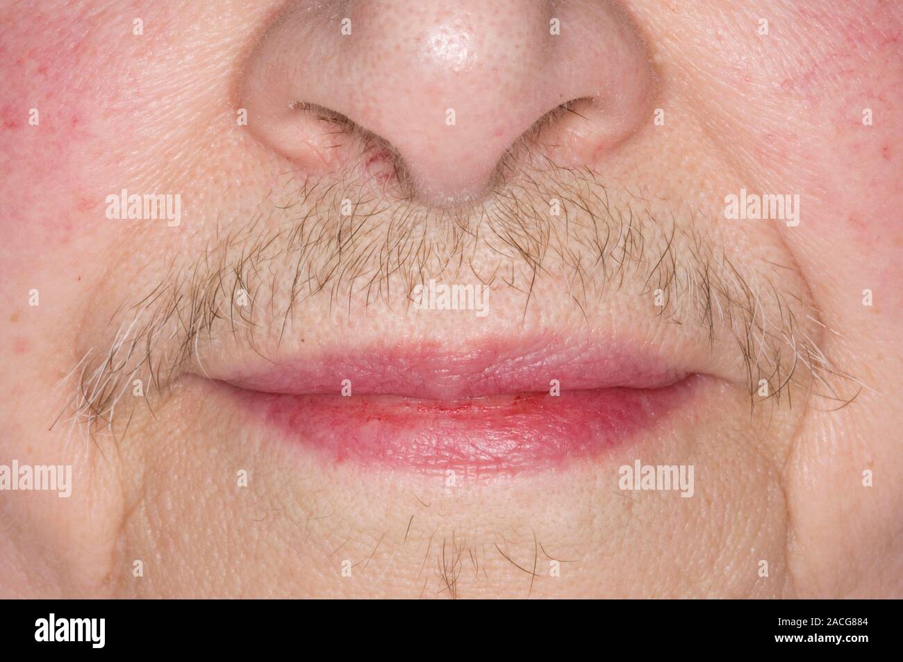 Close-up of the face of an adult female patient, showing hirsutism ...