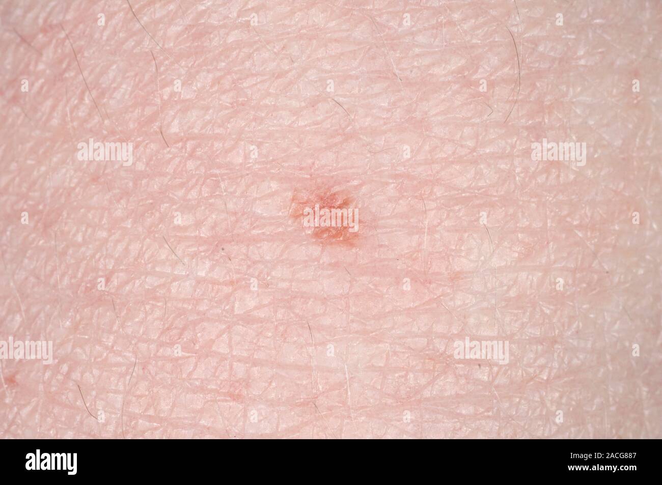 Close-up of a mole (naevus) on the skin in a 46 years old female ...