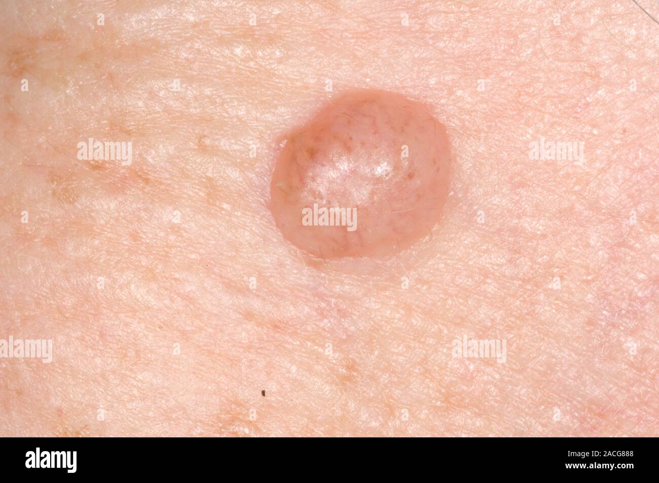 Junctional Naevus Mole On The Skin Stock Image C013 Junctional naevus ...