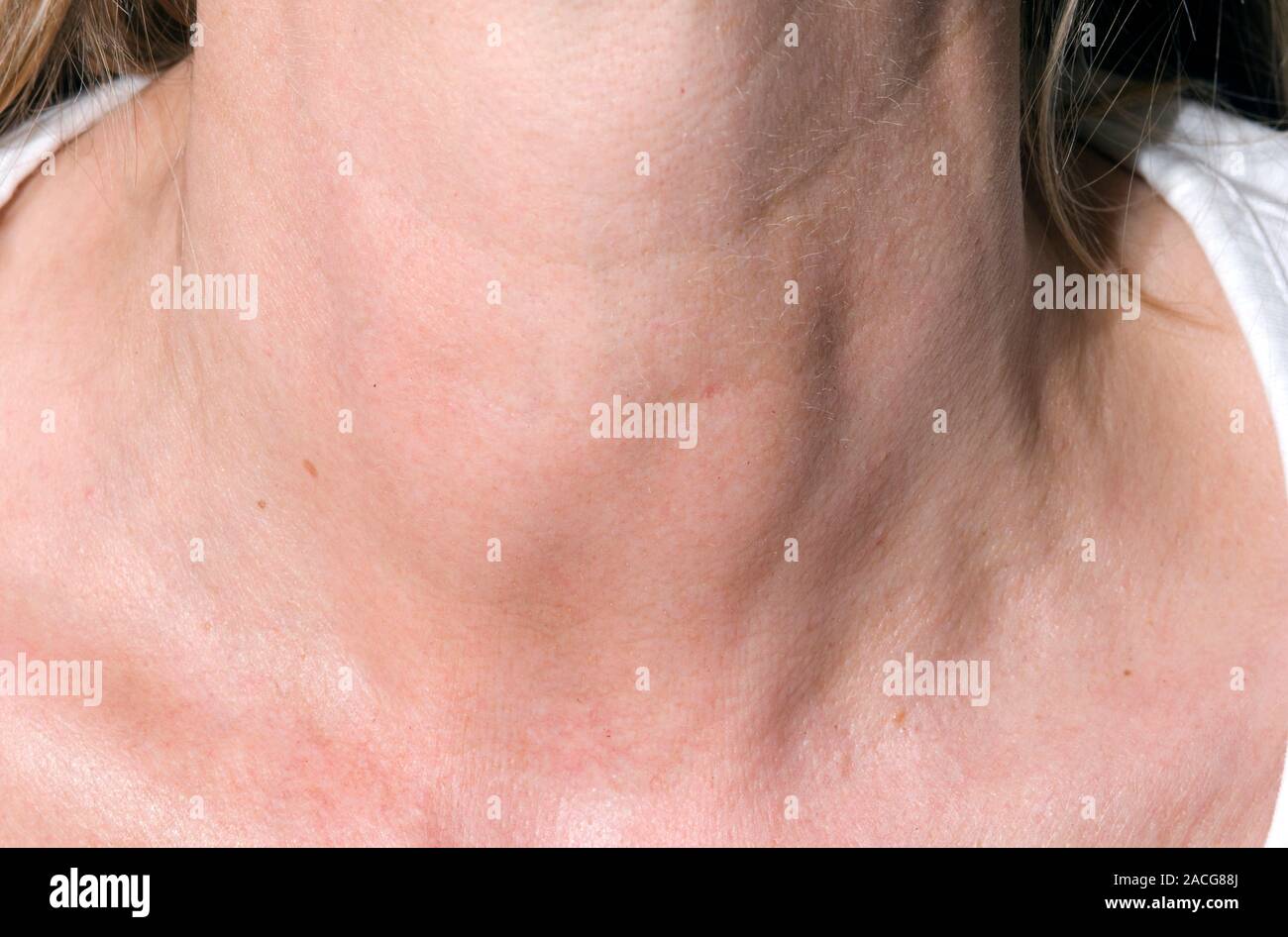 Close-up of the neck of an adult female patient showing acute ...