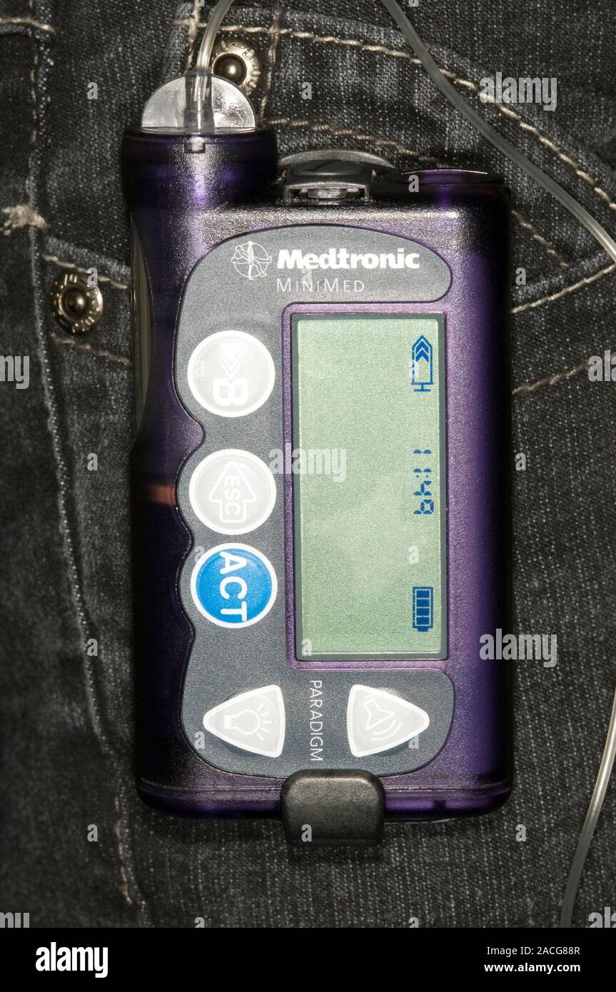 Digital insulin pump attached to a trouser pocket and carried around by ...