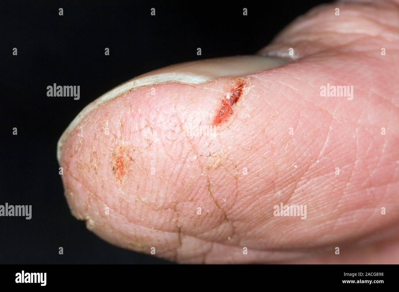 Close-up of the thumb of an adult male patient, showing splits in the ...
